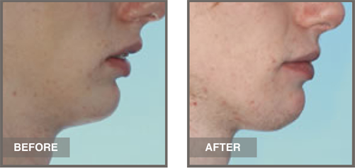 Before and After - Skin Laxity Loss - Christopher Tiner MD